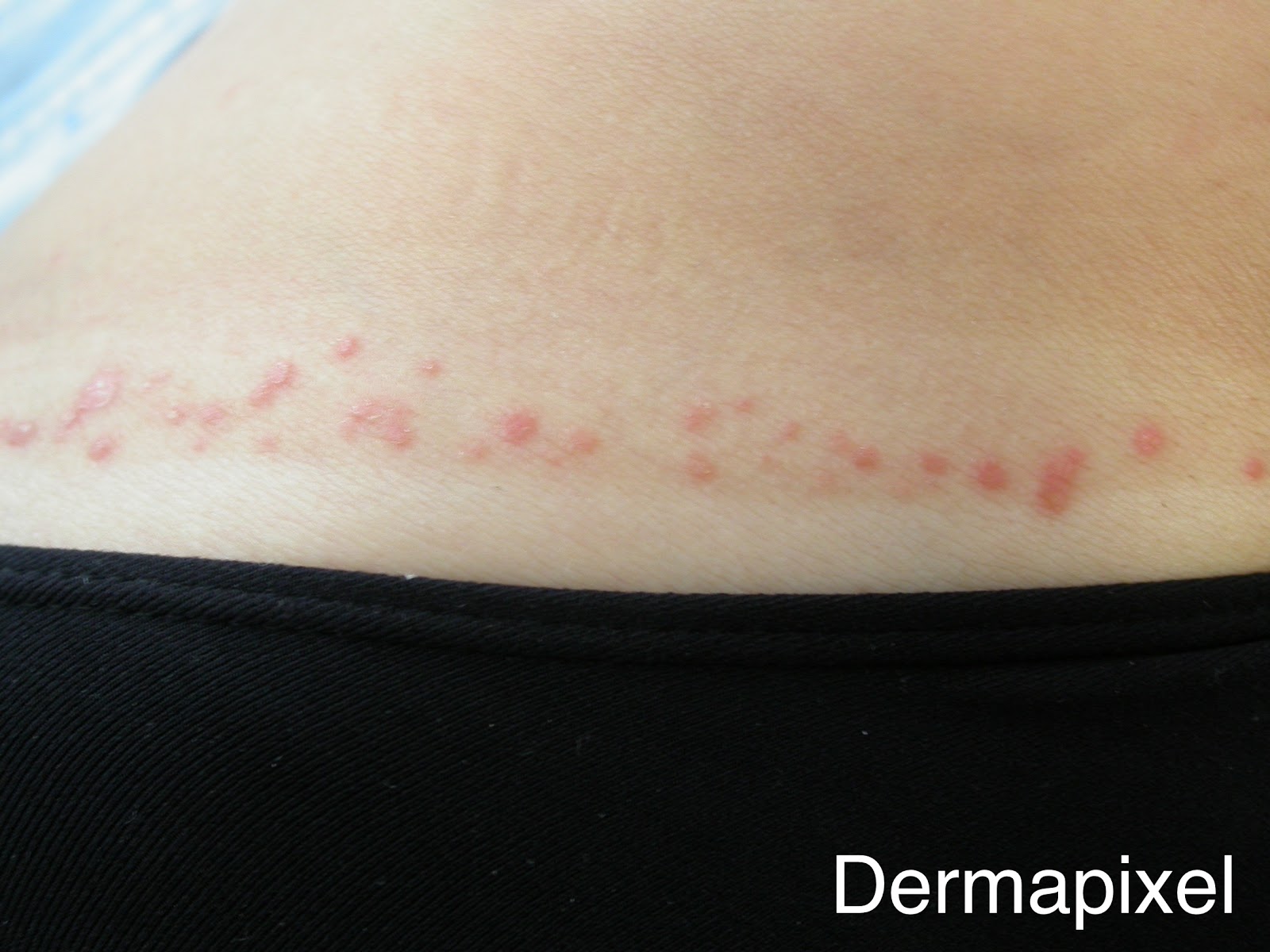 Ejemplos de fenómeno de Koebner en enfermedades de la piel